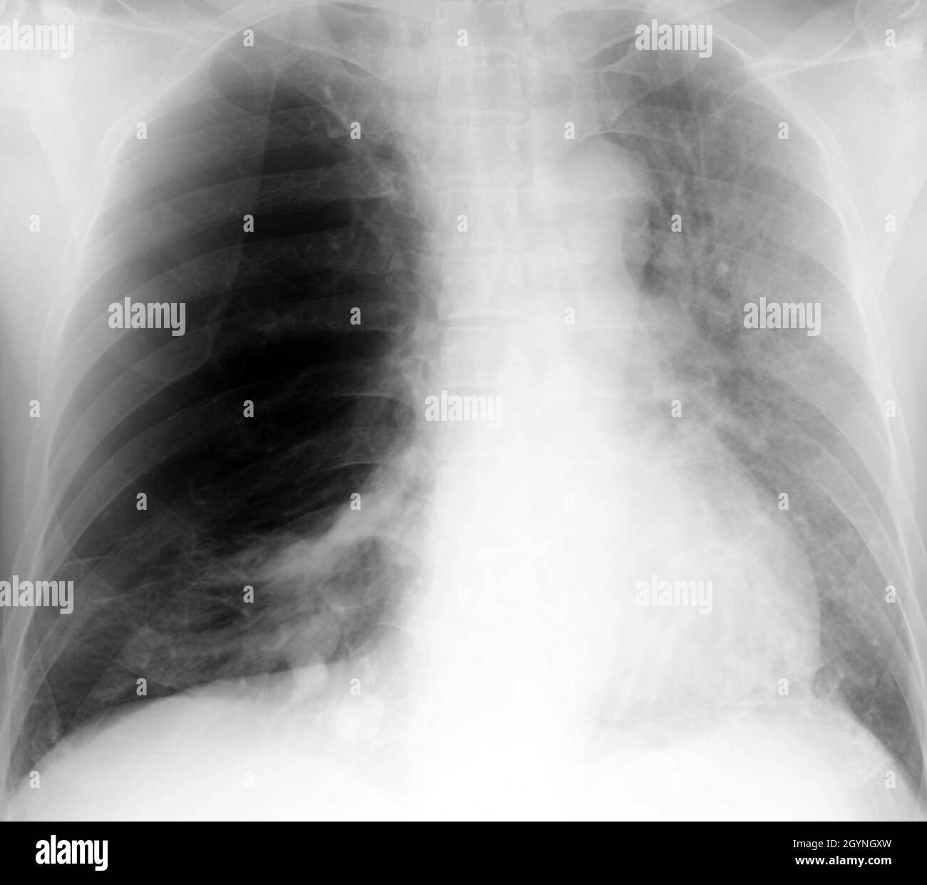 Maladie pulmonaire chronique Banque d'images noir et blanc - Alamy