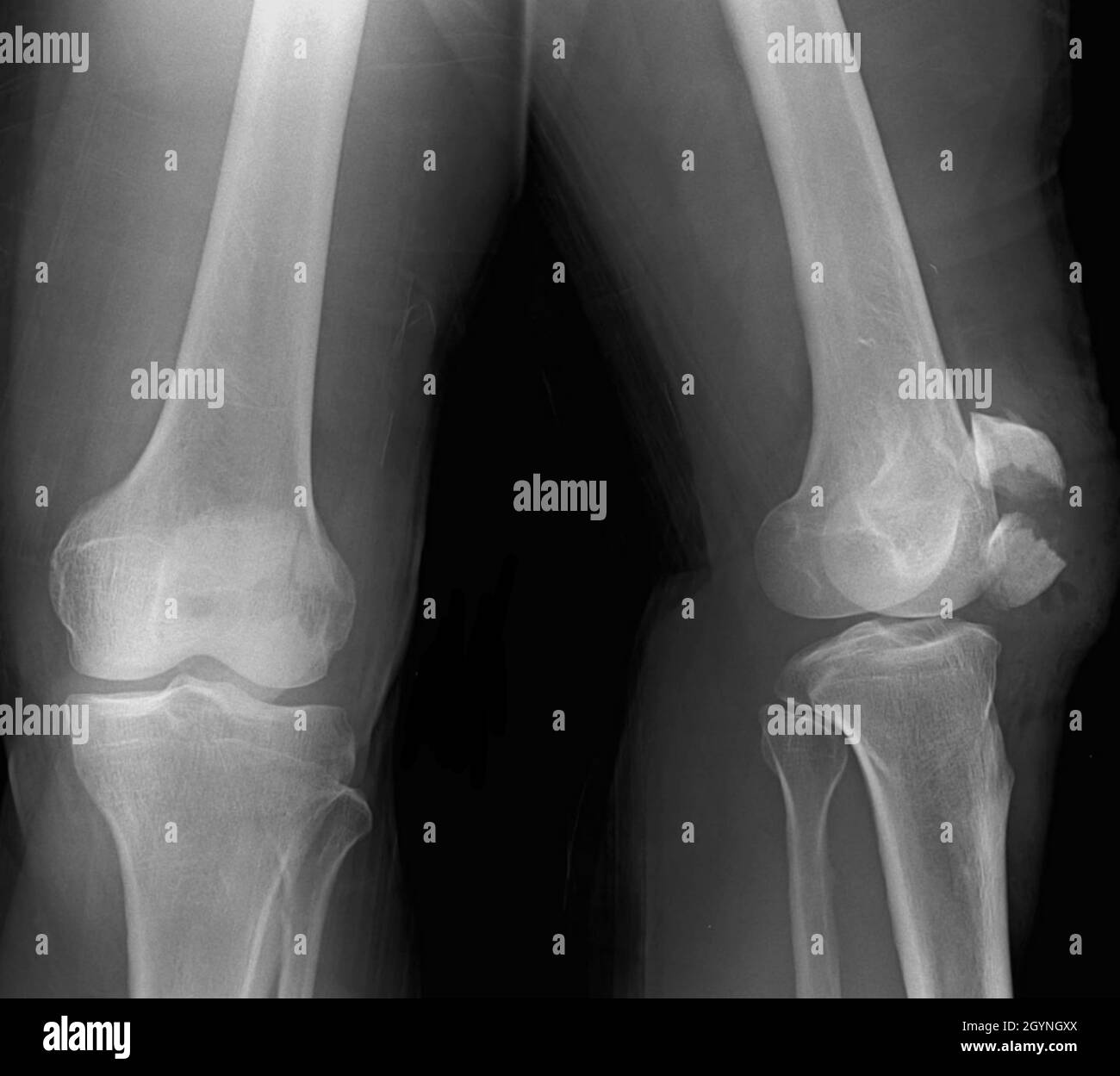 Fracture du genou Banque de photographies et d’images à haute ...