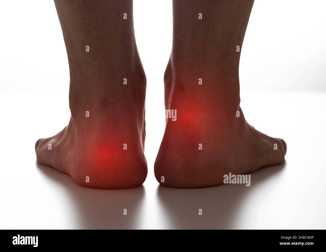 Taches rouges sur les jambes femelles foncées.Concept de douleur et d ...