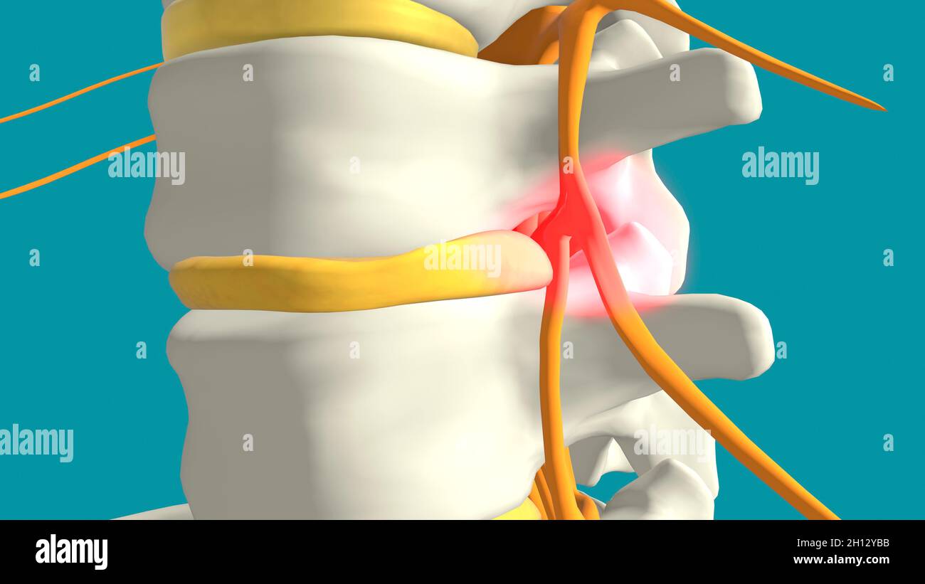 Prolapsus discal Banque de photographies et d’images à haute résolution ...