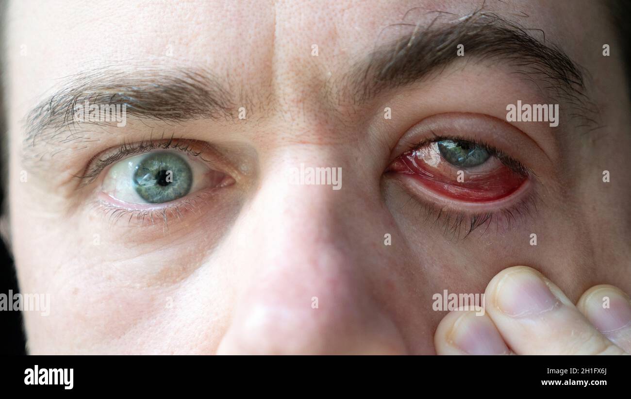 Conjonctivite oculaire Banque de photographies et d’images à haute ...