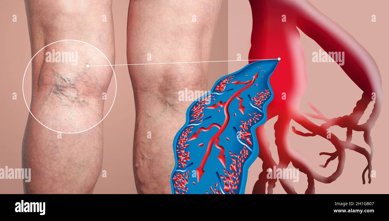 Varices sur les jambes d'une femme senior. La structure de la normale ...
