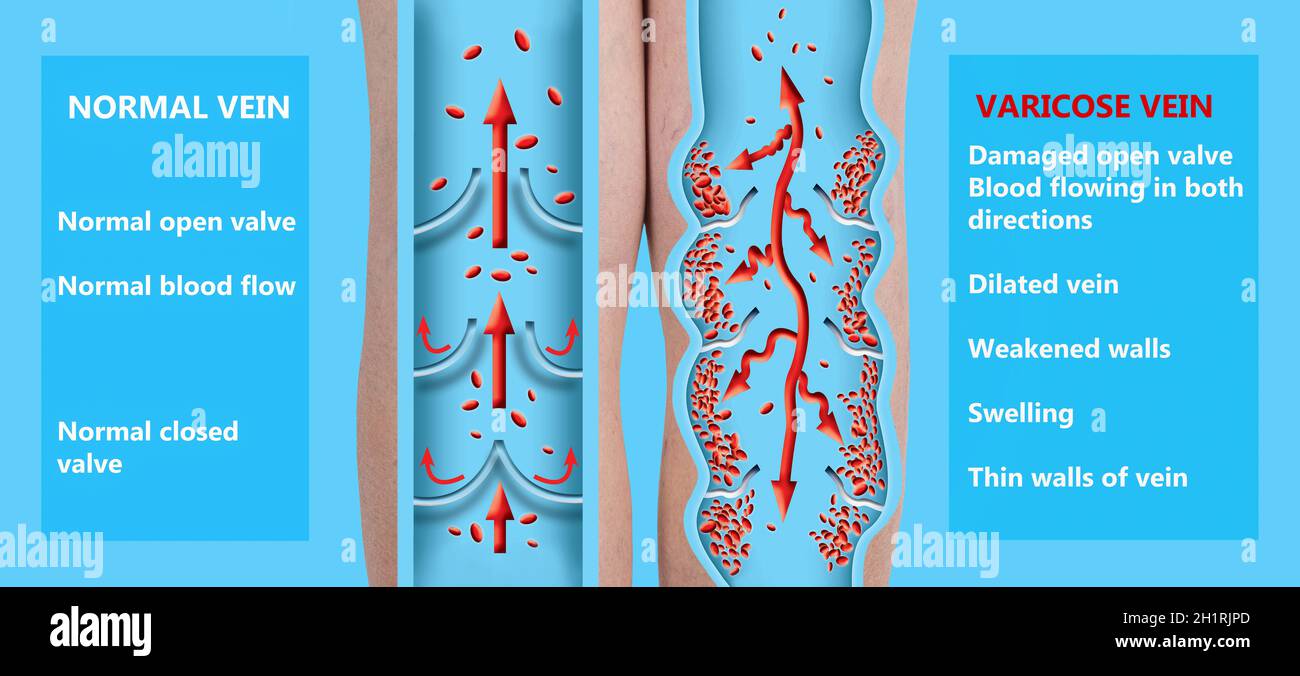 Varices sur les jambes de la femme. La structure des varices et ...
