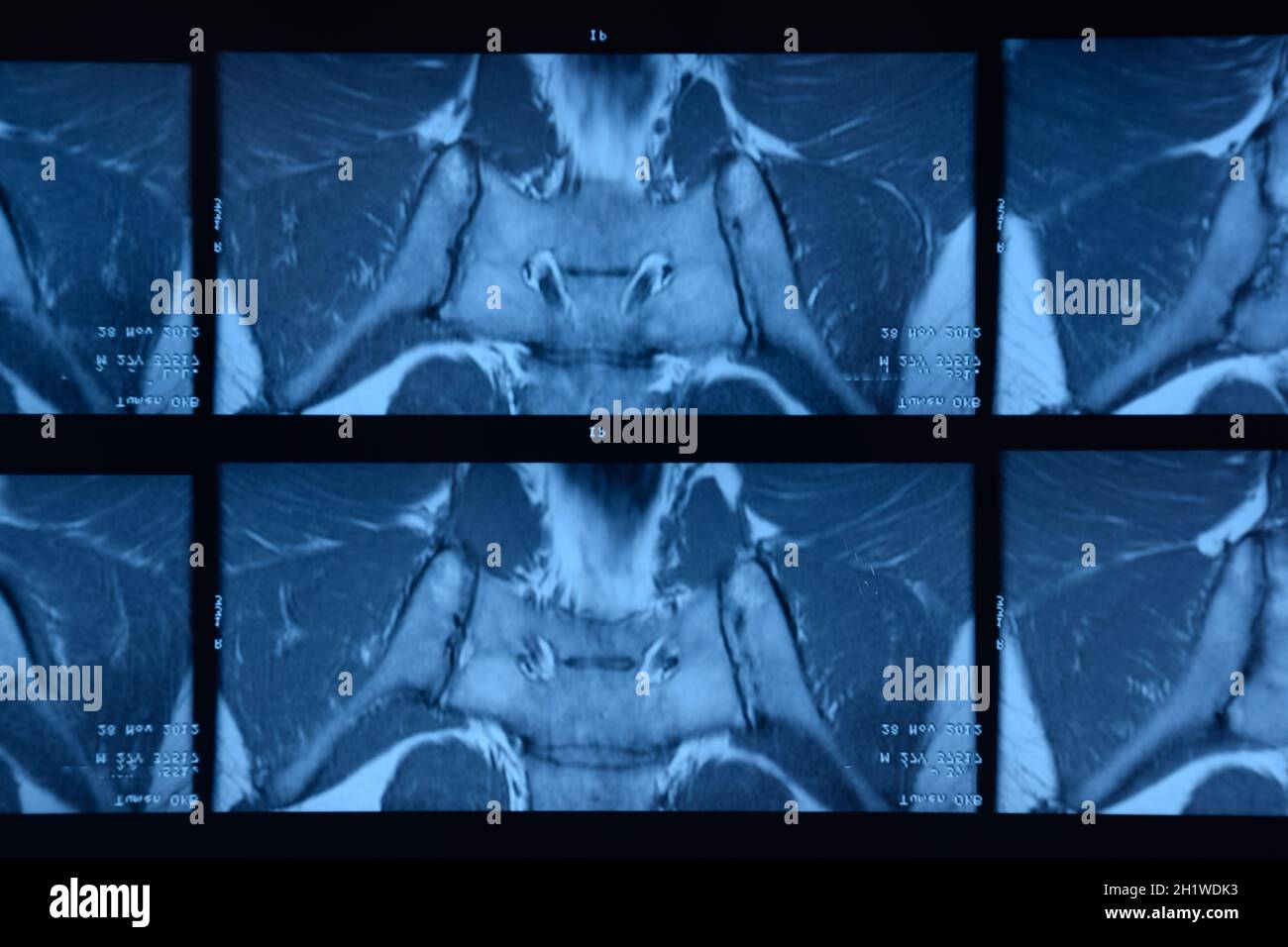 L'IRM de l'articulation sacro-iliaque. Étude de la spondylarthrite ...