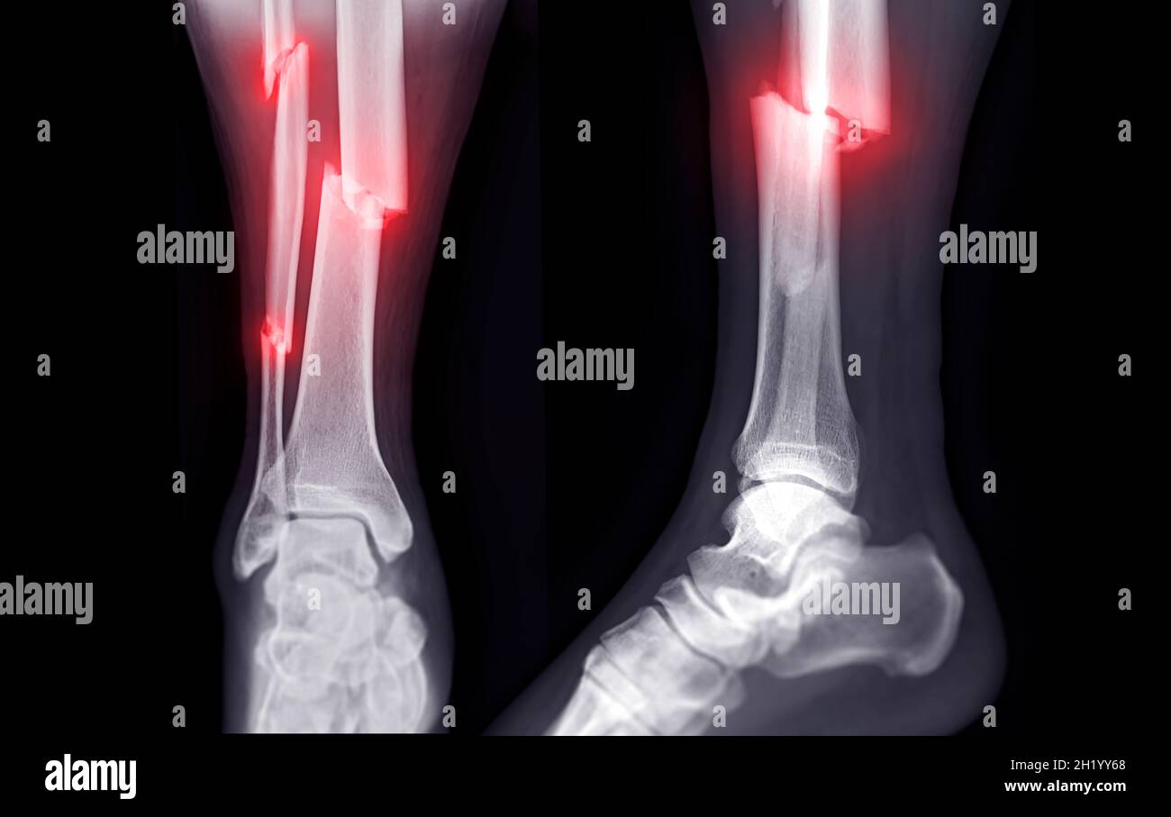 Image radiographique de l'articulation de la cheville montrant une ...