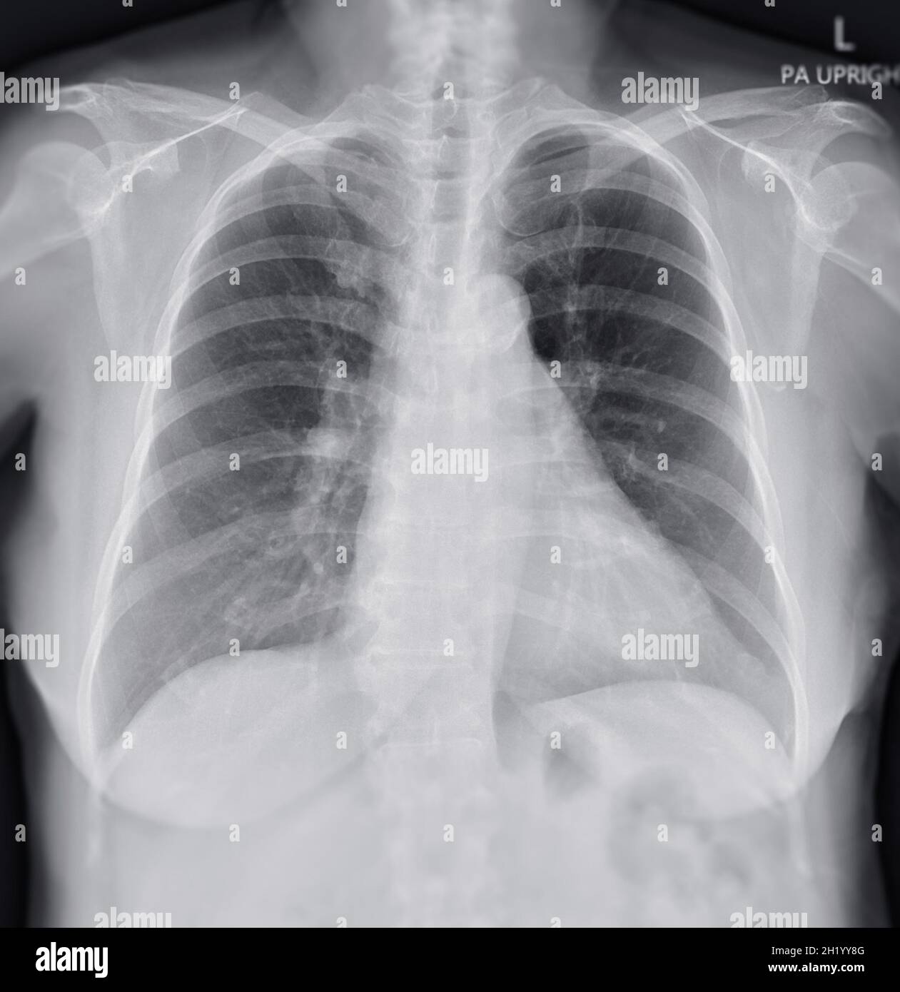 Radiographie thoracique du thorax ou du poumon humain montrant un ...
