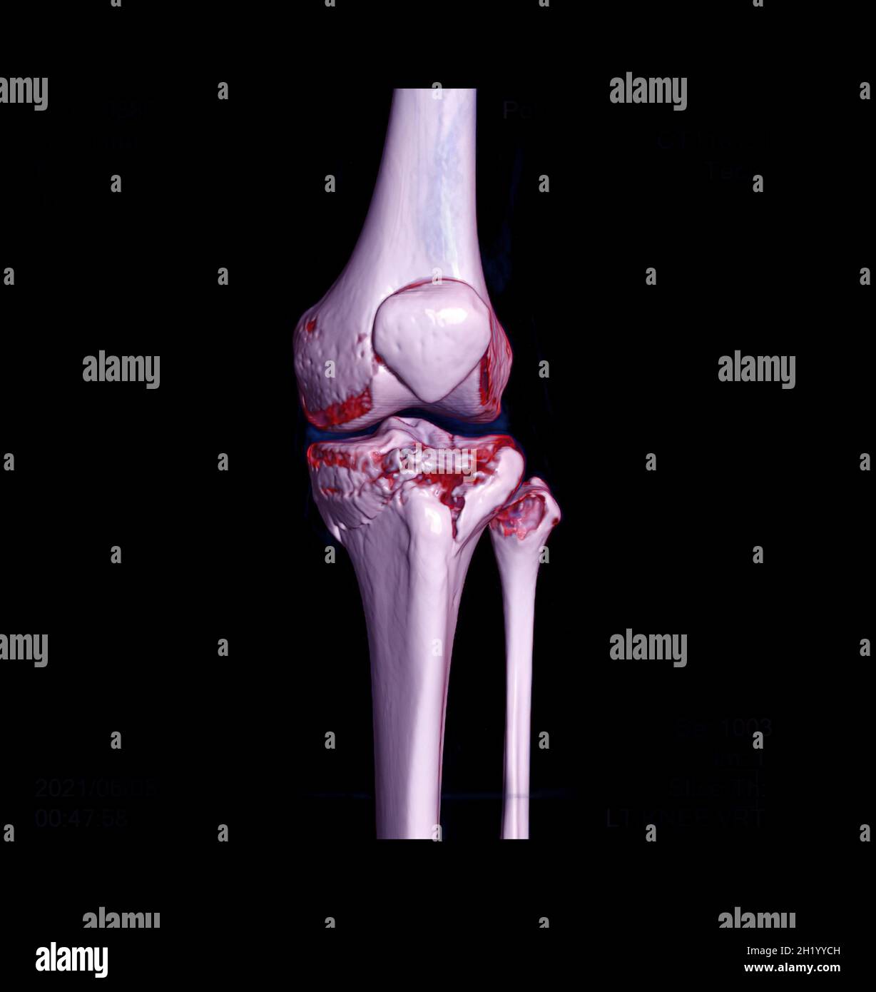 Image de rendu 3D CT de l'articulation du genou montrant l'os du tibia ...