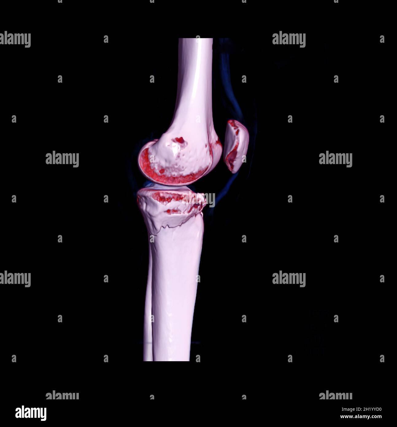 Tibia fracture Banque de photographies et d’images à haute résolution ...