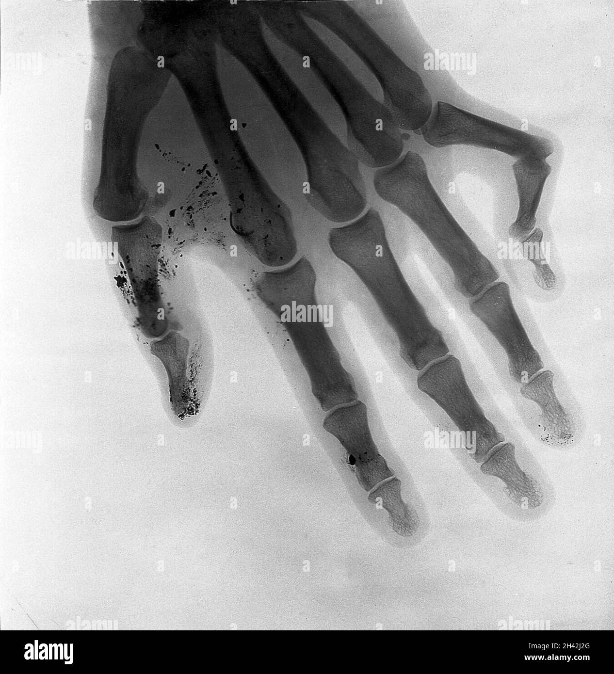 Os d'une main.Radiographie, 1900/1904 Photo Stock - Alamy