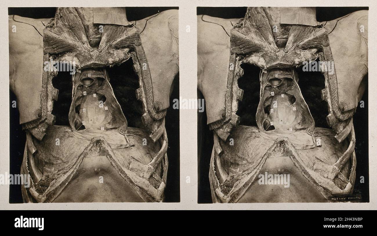 Anatomie : dissection du thorax montrant le cœur et le péricarde ...