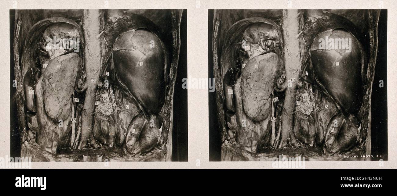 Anatomie : dissection de la région lombaire montrant les relations ...