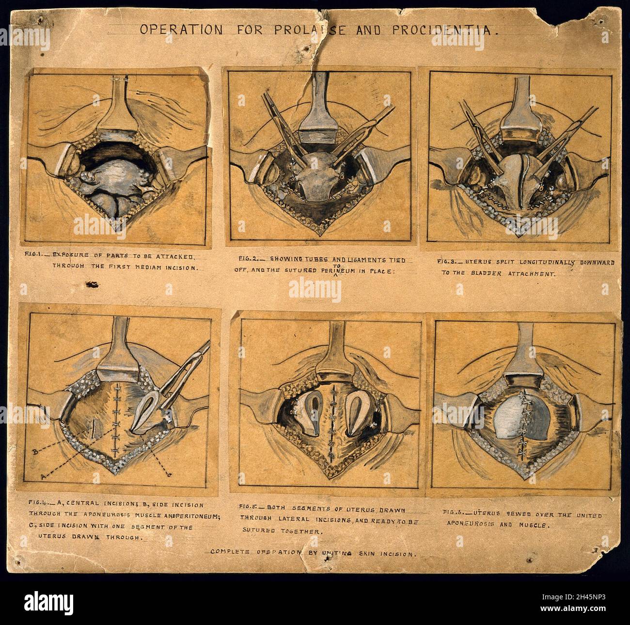 Six diagrammes illustrant une opération pour un utérus ou une ... Six diagrammes illustrant une opération pour un utérus ou une ...