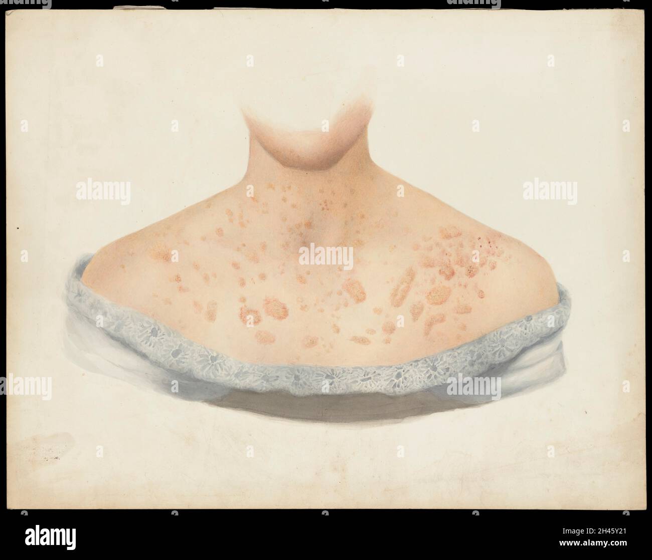 La poitrine d'une femme atteinte d'une maladie de la peau désignée ...