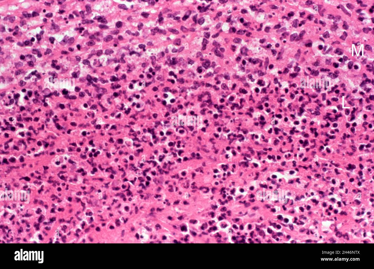 Leishmaniose cutanée : lésion cutanée Photo Stock - Alamy