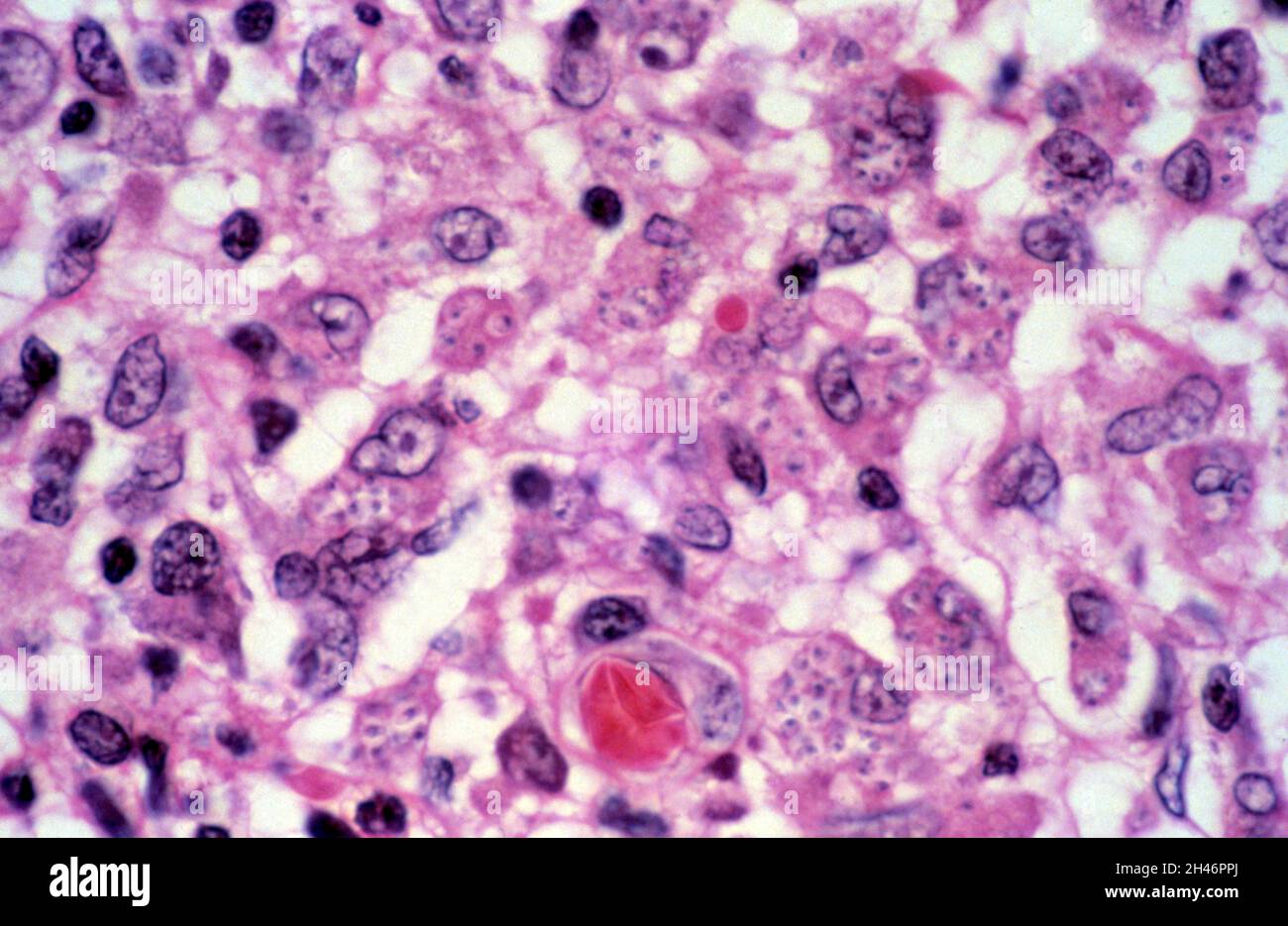 Leishmaniose cutanée : lésion cutanée Photo Stock - Alamy