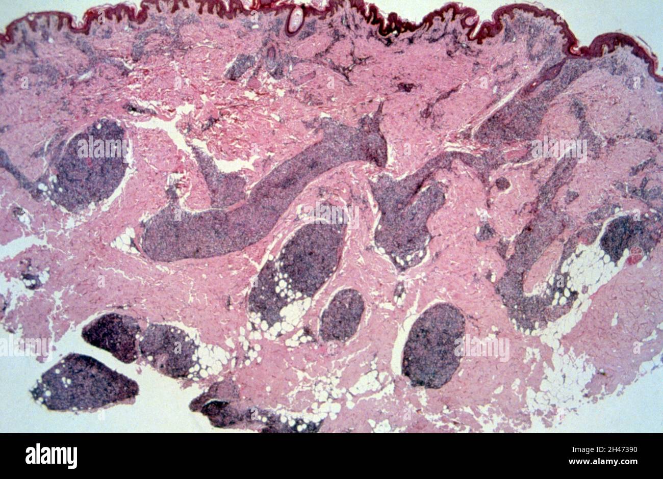 Leishmaniose cutanée (CL) : lésion cutanée Photo Stock - Alamy