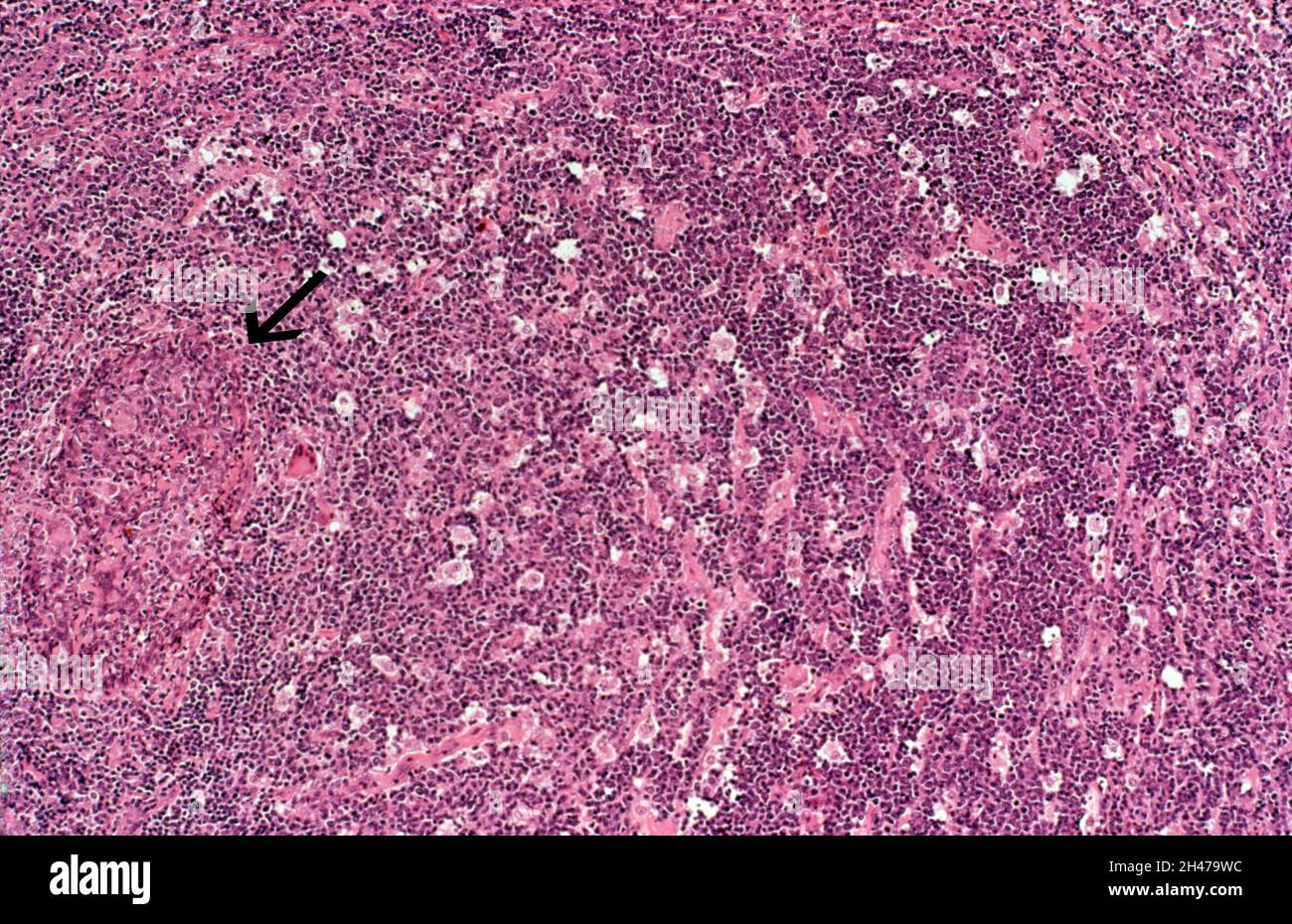Glande parotide : kyste lymphoépithélial avec VIH Photo Stock - Alamy