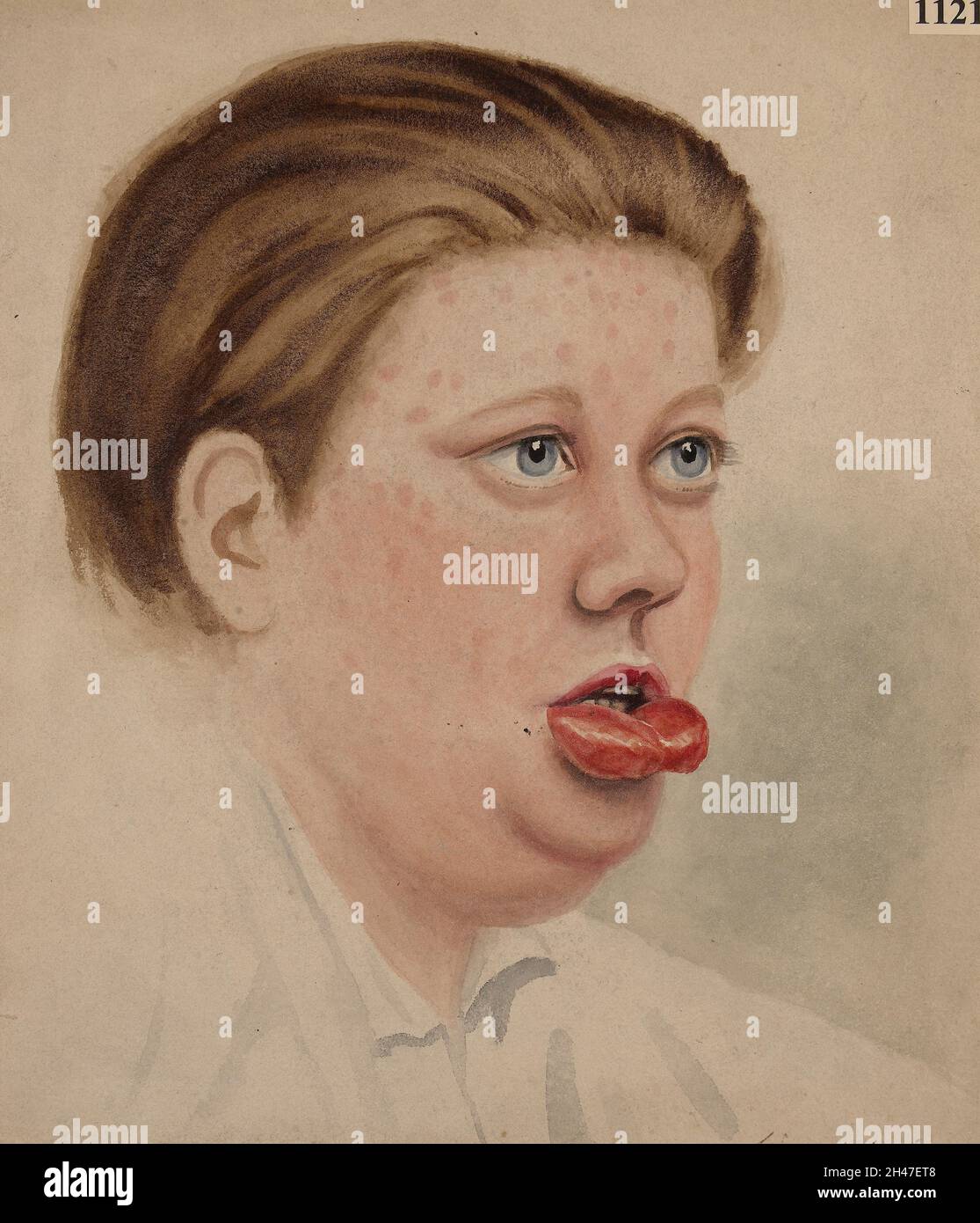 Visage d'une fille avec une plaie syphilitique primaire sur la lèvre ...