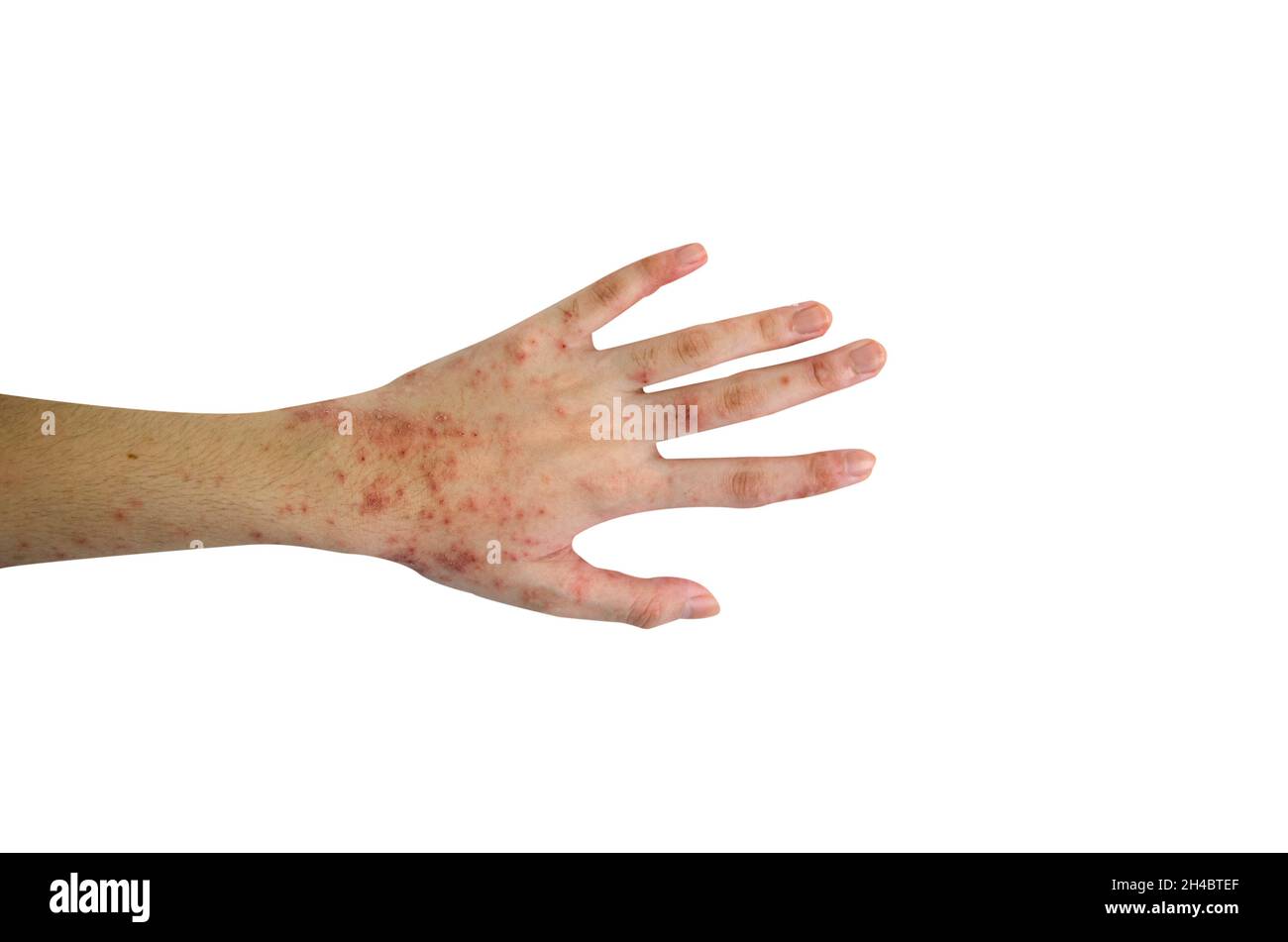 Psoriasis sur le bras et la main Banque de photographies et d’images à ...