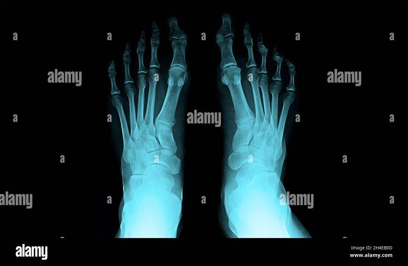image de radiographie de la cheville gauche et droite du pied humain ...