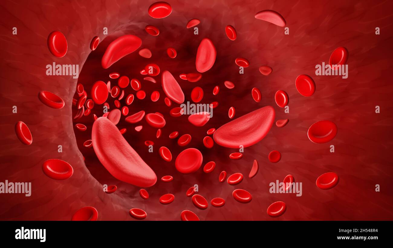 L'anémie de cellules de faucille, illustration Photo Stock - Alamy