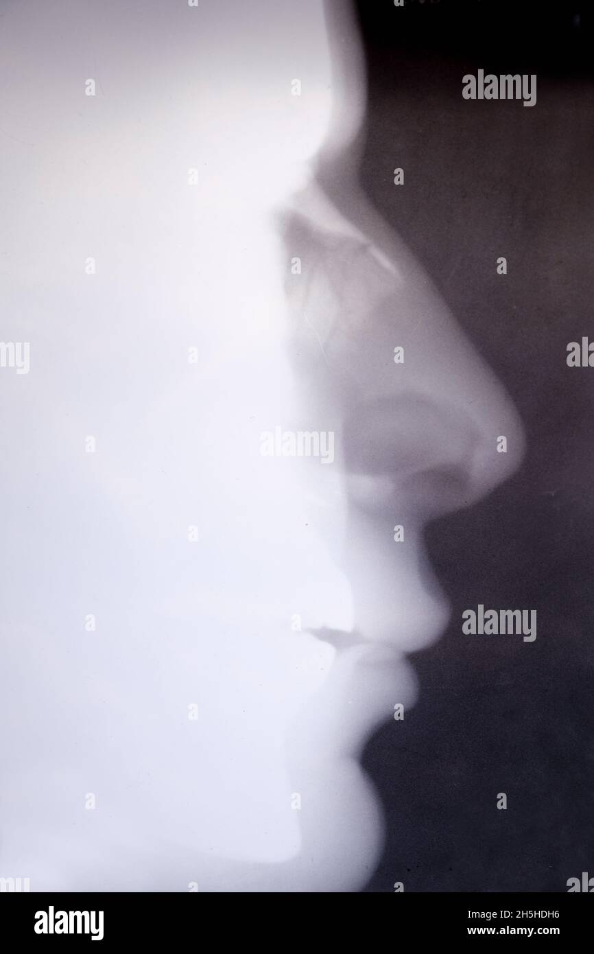 Os de la mâchoire cassé Banque de photographies et d’images à haute ...