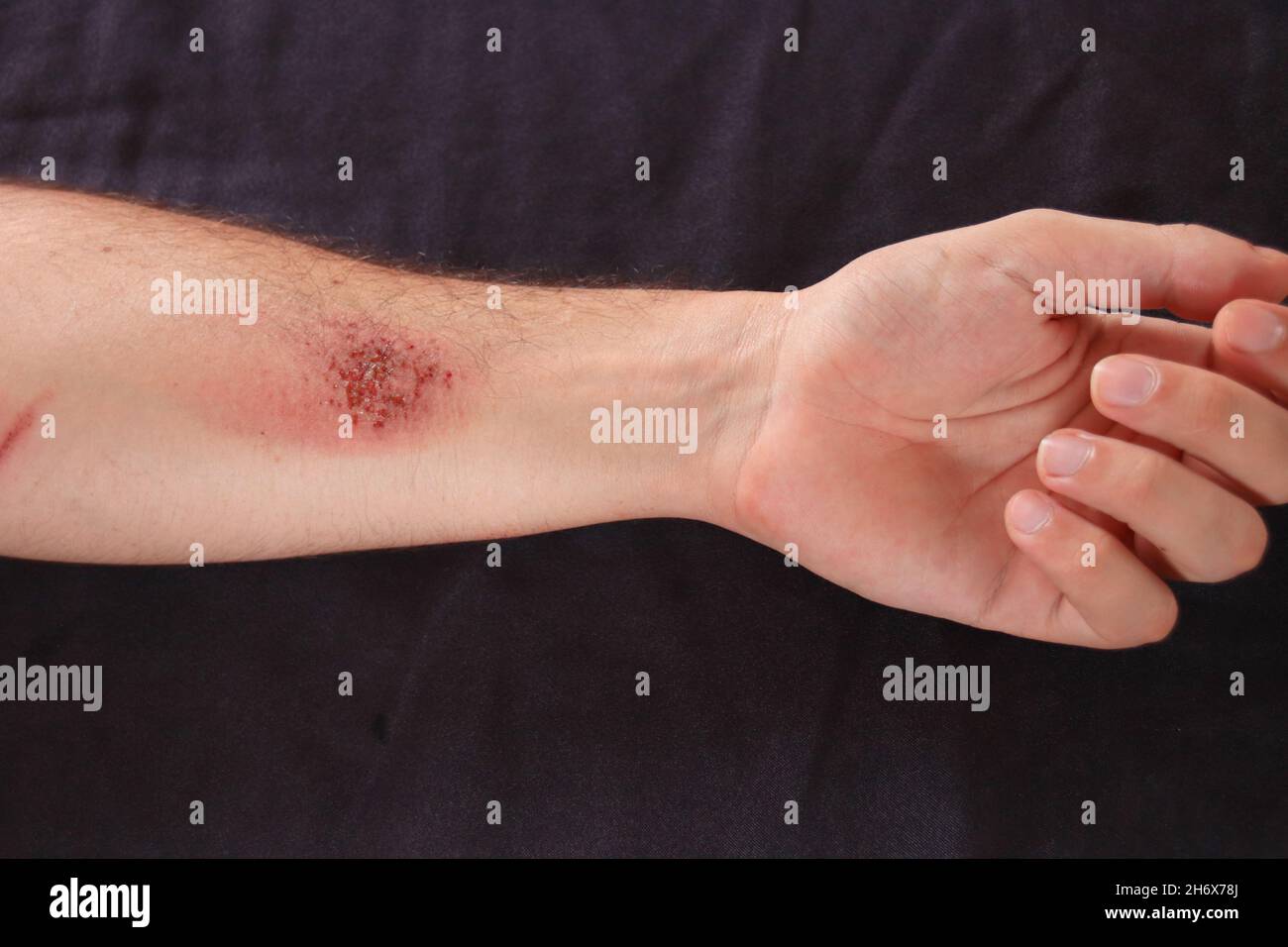 Abrasions cutanées Banque de photographies et d’images à haute ...