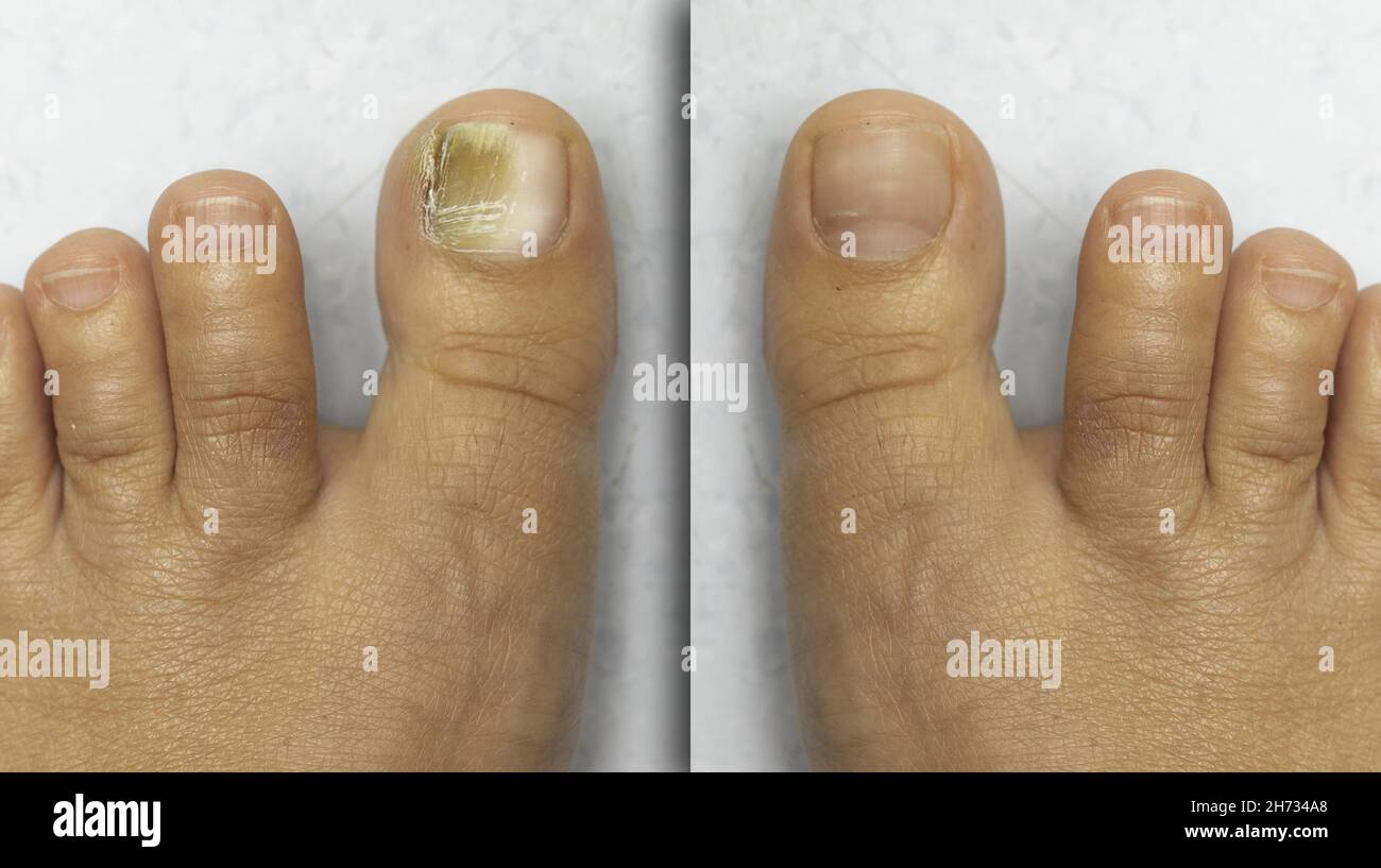 Avant et après un traitement réussi pour une infection fongique sur le ...