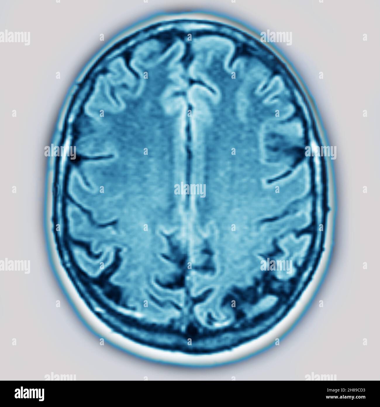 Cerebral atrophy brain Banque de photographies et d’images à haute ...