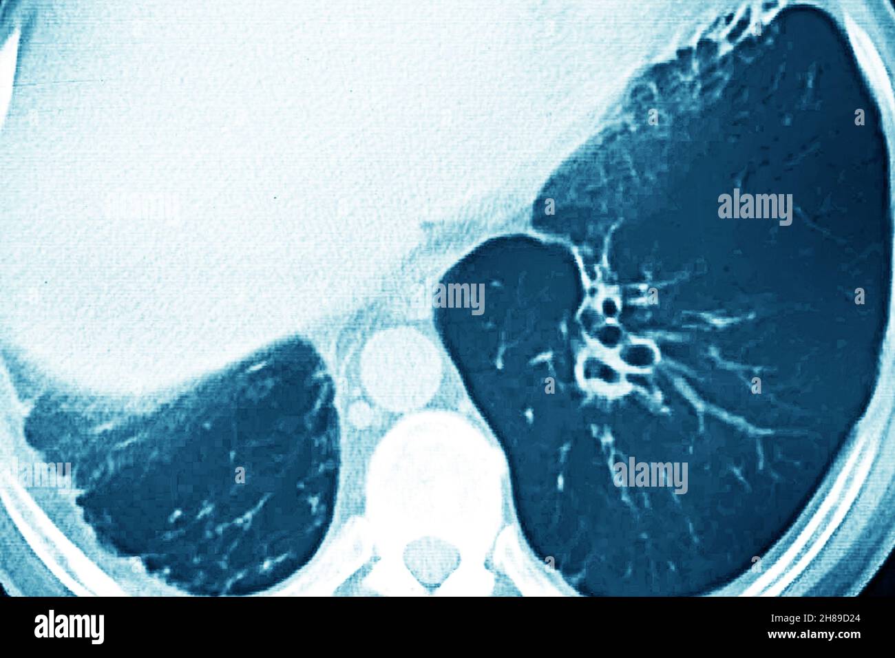 Test de fibrose kystique Banque de photographies et d’images à haute ...