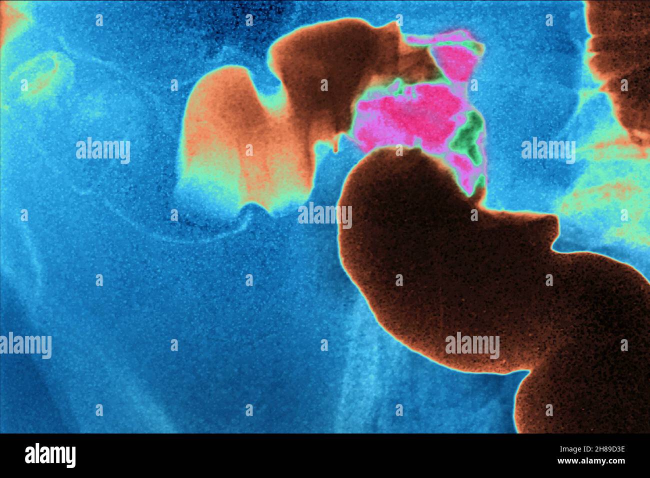 Cancer du sigmoïde Banque de photographies et d’images à haute ...