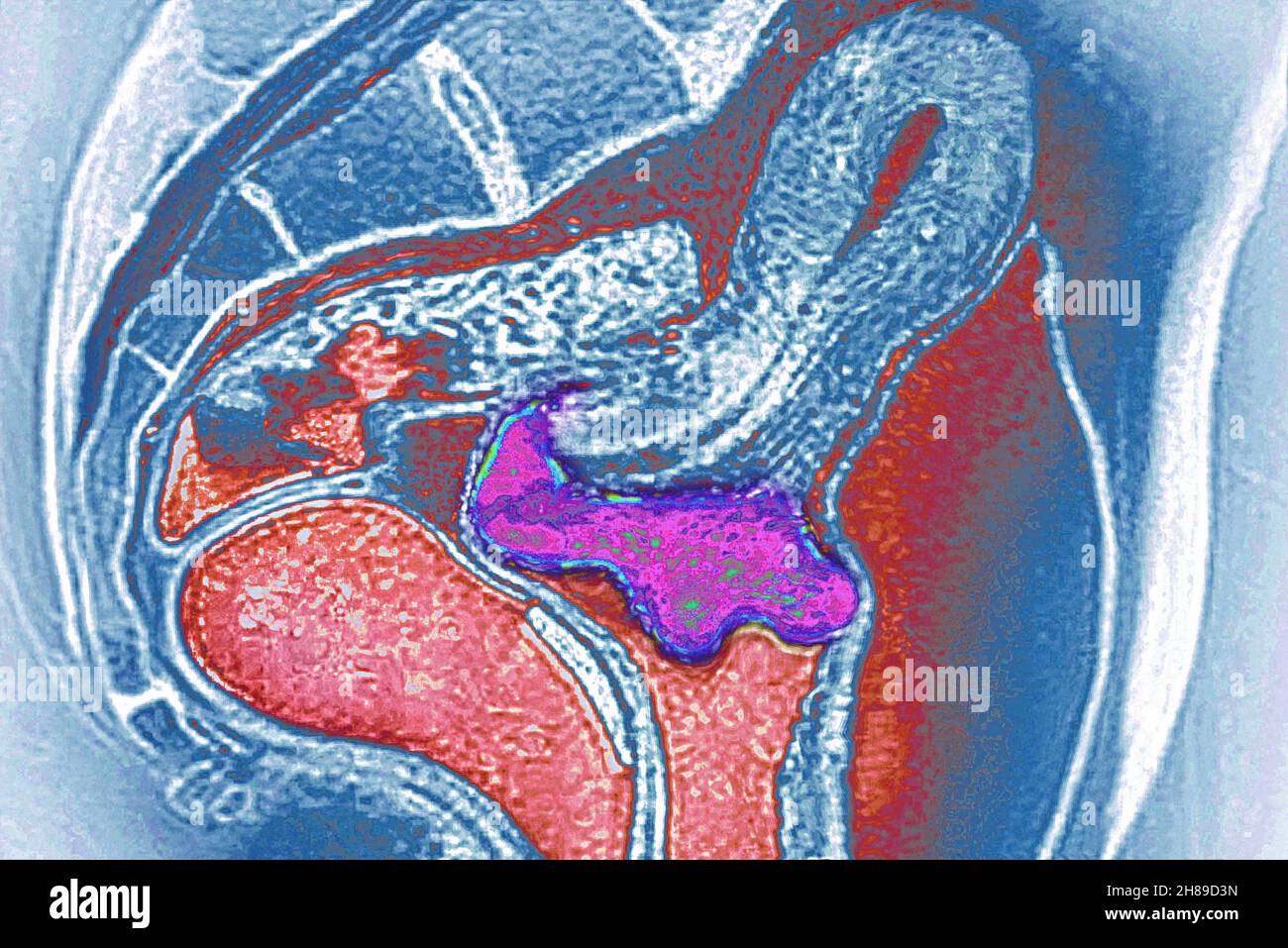 Carcinome du col utérin Banque de photographies et d’images à haute ...