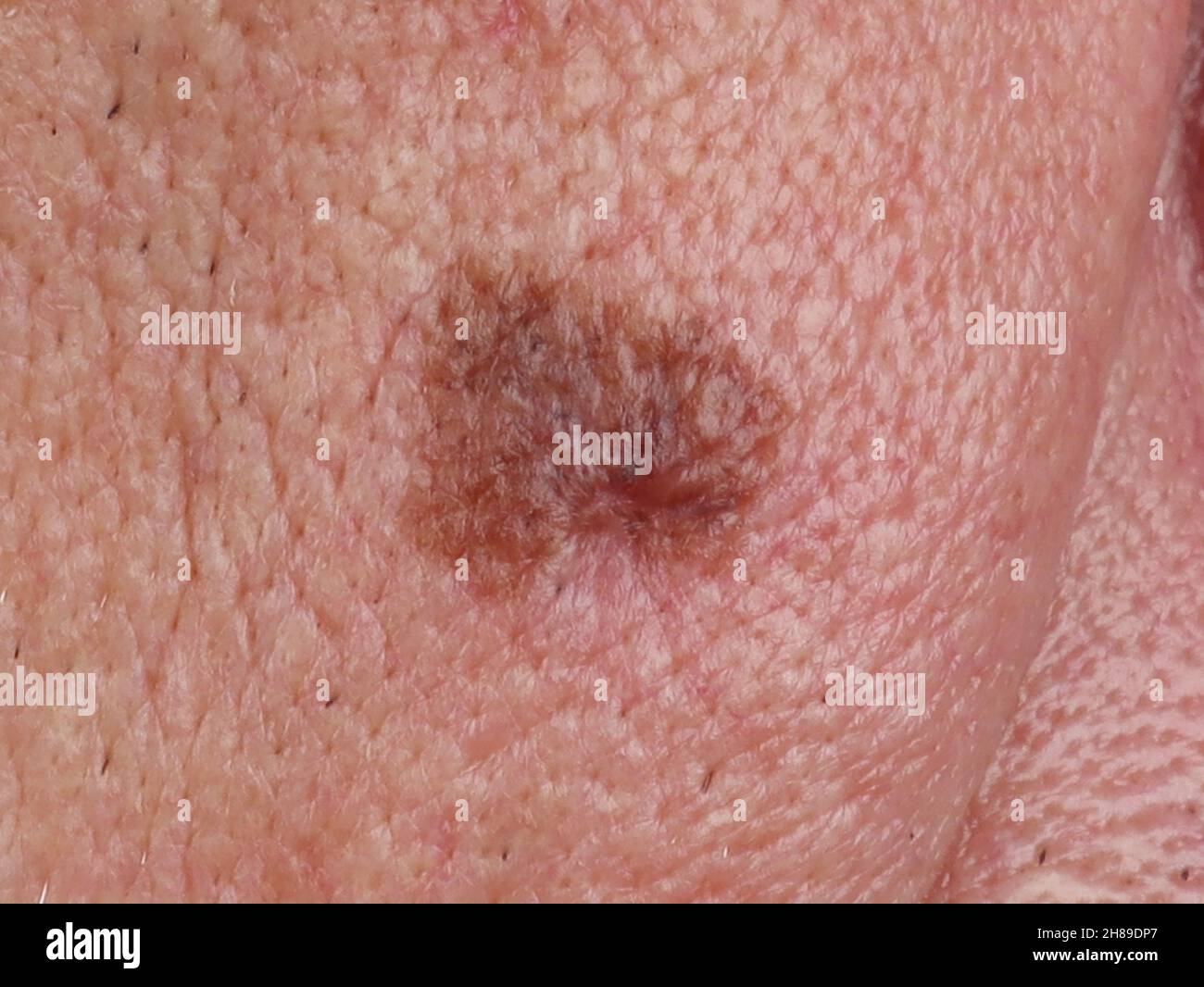 Mélanome de dubreuilh Banque de photographies et d’images à haute résolution - Alamy