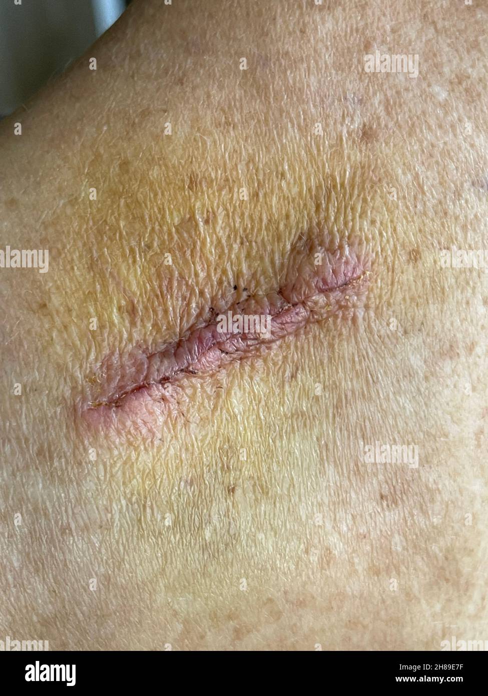 Chirurgie de la cicatrice lipome Banque de photographies et d’images à ...