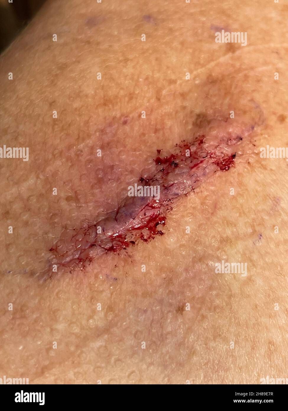 Chirurgie de la cicatrice lipome Banque de photographies et d’images à ...