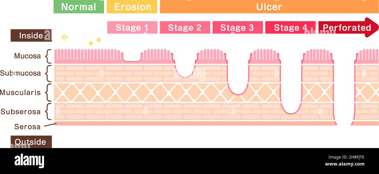 Inflammation ulcer Banque de photographies et d’images à haute ...