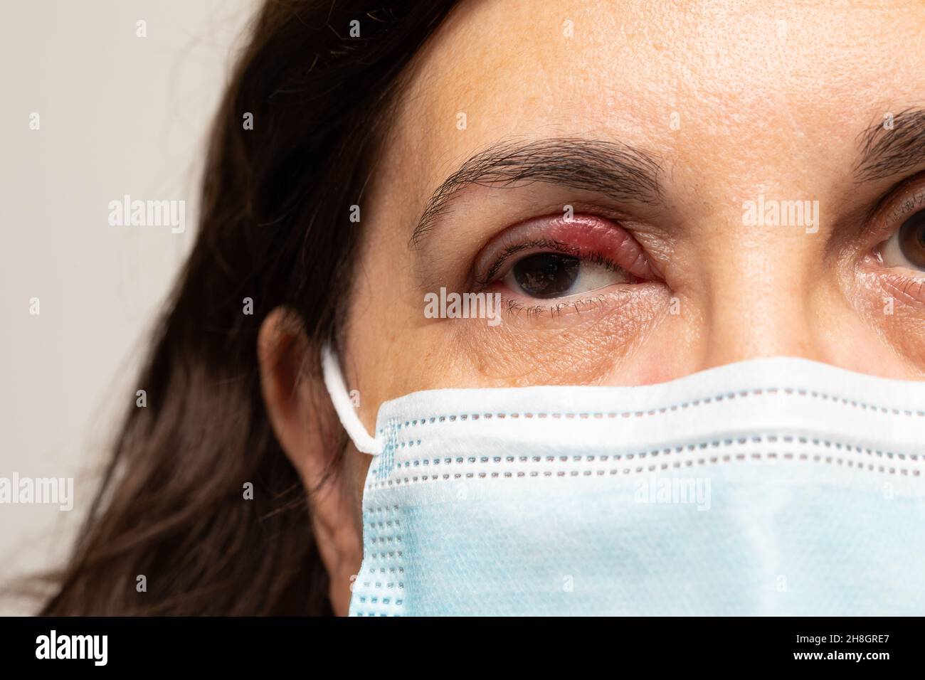 Swollen eyelid Banque de photographies et d’images à haute résolution ...