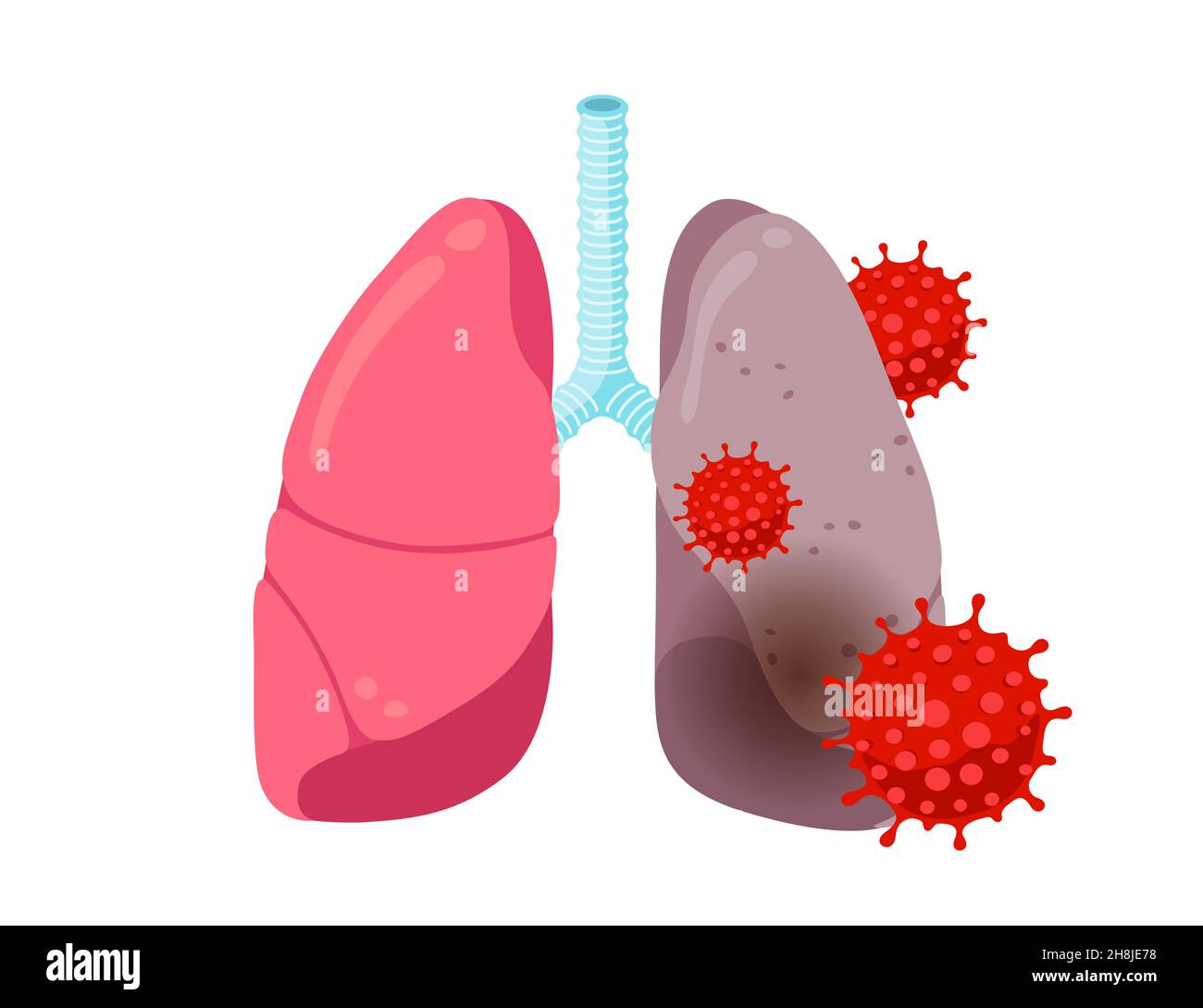 Des poumons sains et malades malsains atteints d'une maladie à ...