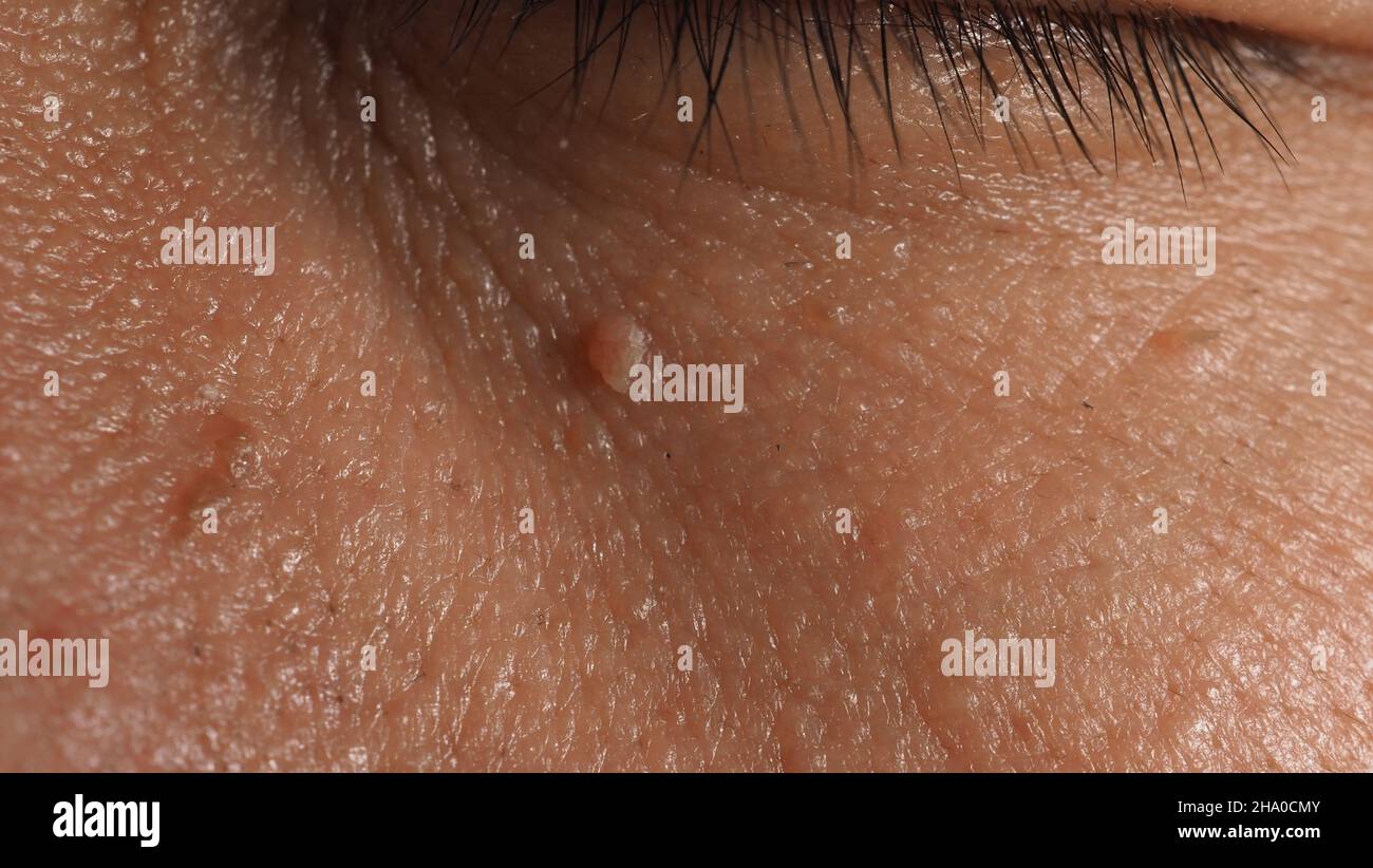 Cancer de la peau mélanome sur le nez Banque de photographies et d ...