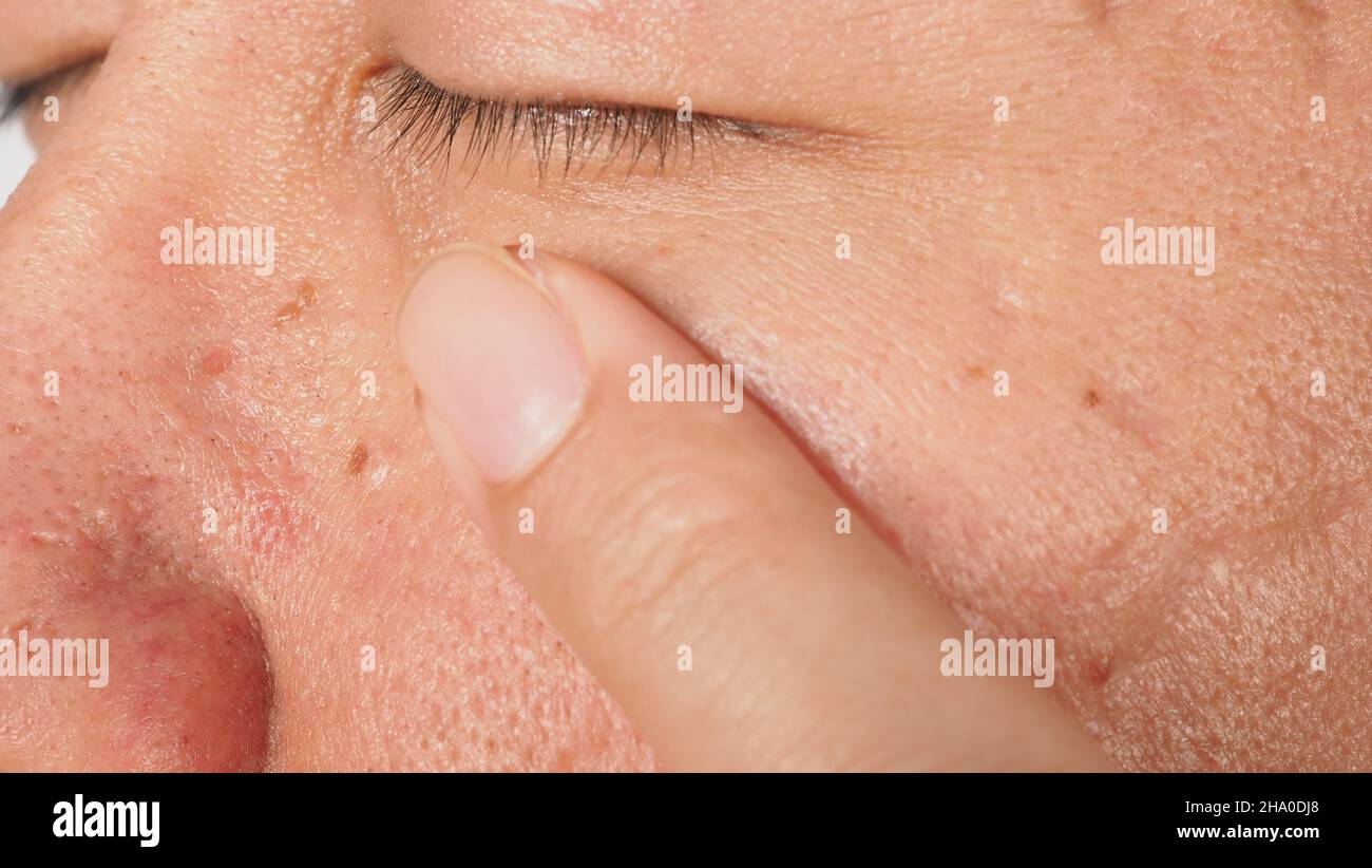 Gauchissement sur la face.Photo macro de la verrue près de l'œil ...