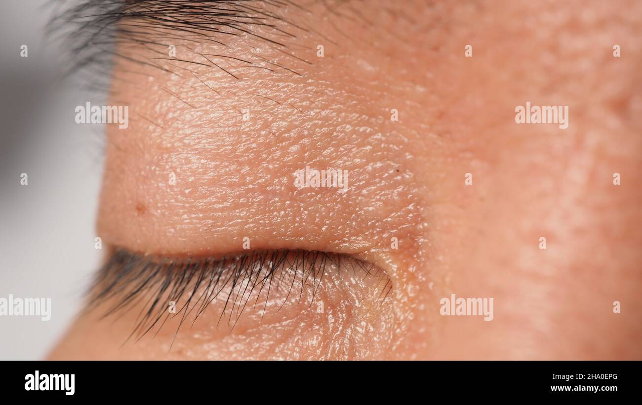 Gauchissement sur la face.Photo macro de la verrue près de l'œil ...
