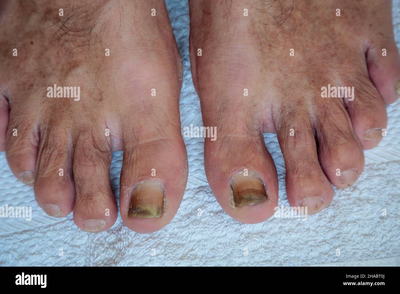 Détails des ongles d'homme avec infection fongique connue sous le nom ...
