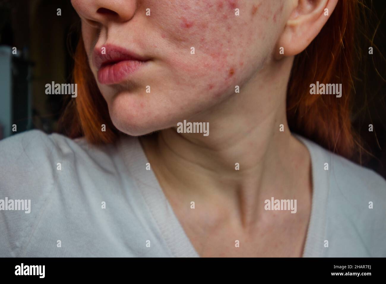 Problème de peau.Éruptions rouges sur le visage de la jeune fille Photo ...