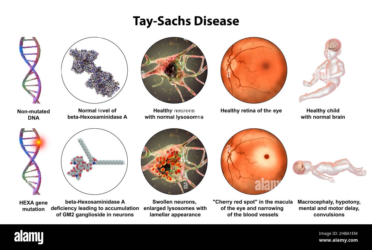 Doenca De Tay Sachs - BRAINCP