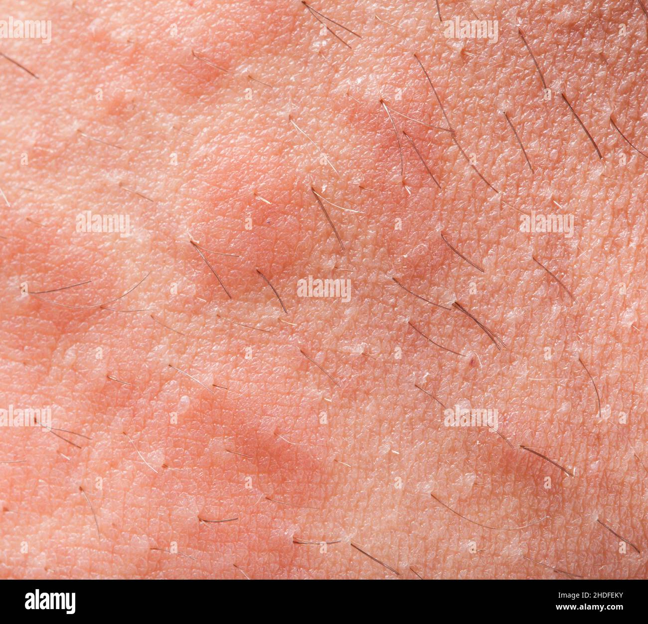 éruption cutanée, urticaire, dermatite, rashs cutanés Photo Stock - Alamy
