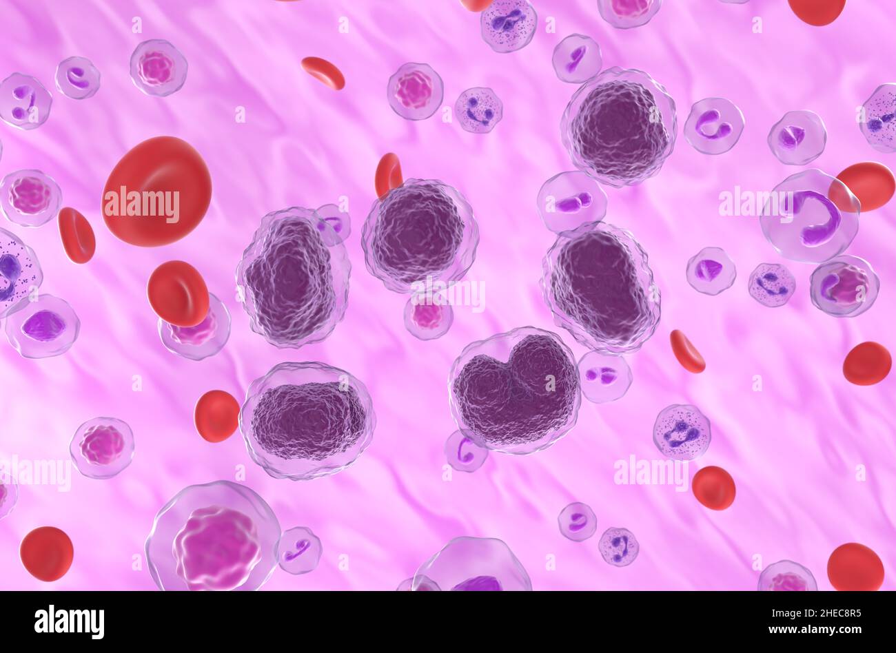 Cellules de lymphome non hodgkinien (LNH) dans le flux sanguin - vue ...