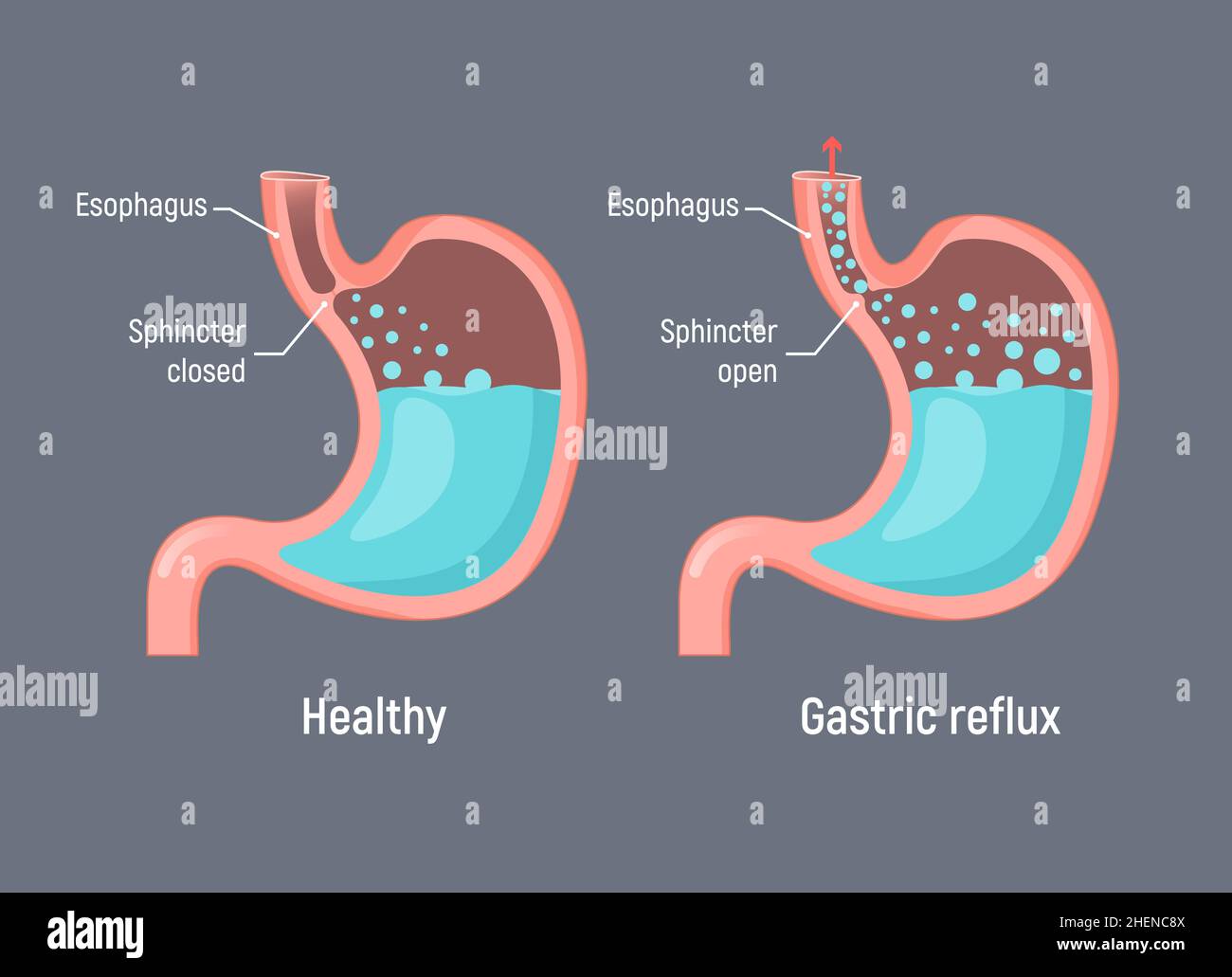 Indigestion de l'acide gastrique de reflux gastrique.Estomac gastro ...