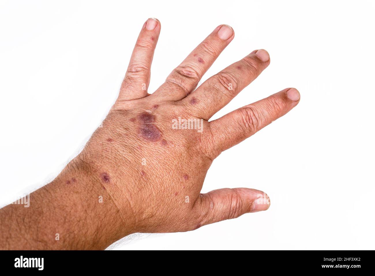 Dermatite allergique sur la peau des mains au vaccin ou à la médecine ...