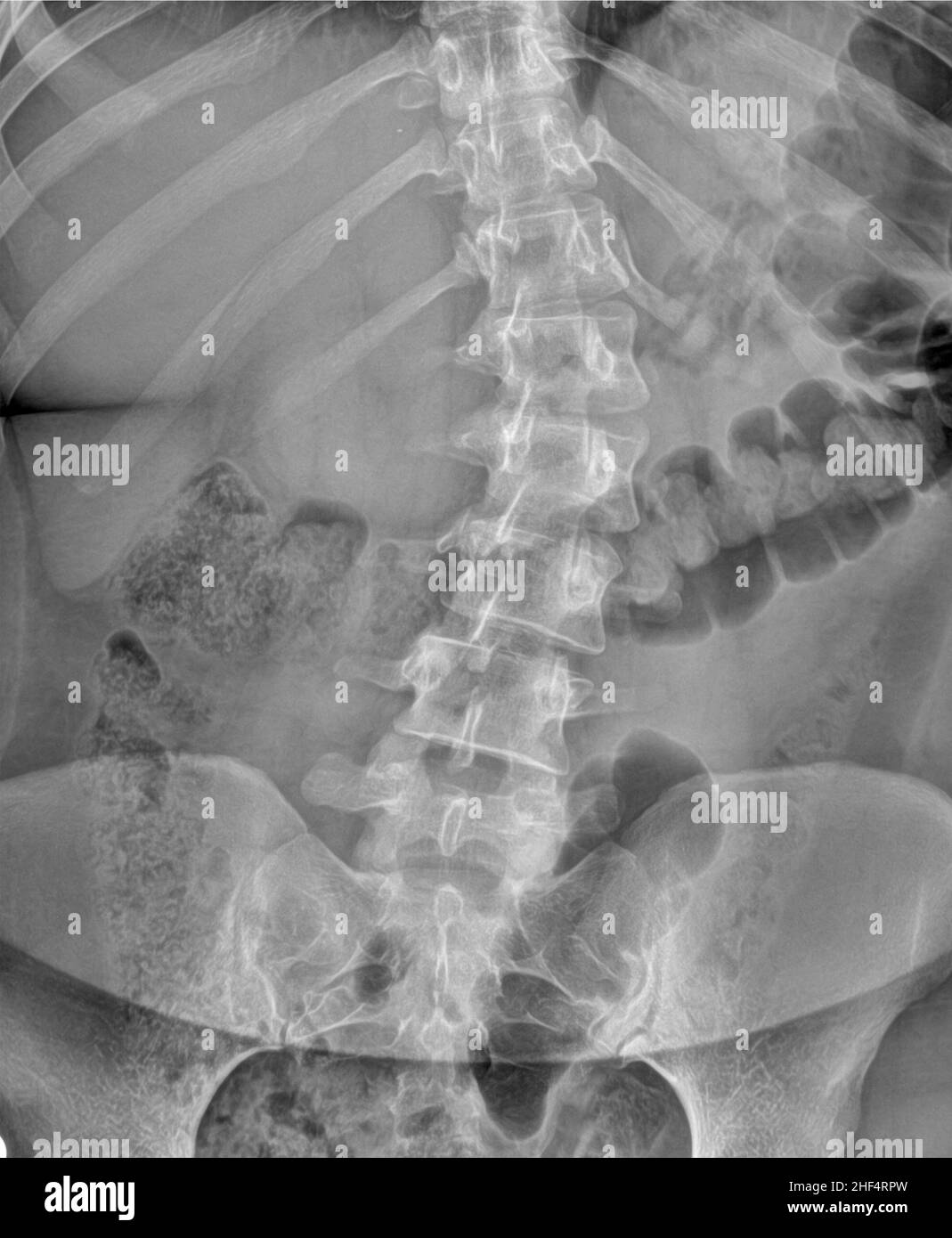 Rachis lombaire radiographie, en projection antéro-postérieure, d'un ...