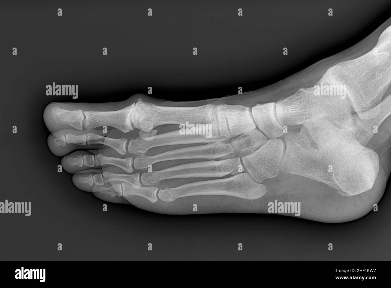 Radiographie des orteils d'un pied, en projection latérale-latérale ...